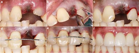 A Preoperative Intraoral Images Showing Complete Dislocation Of Tooth Download Scientific