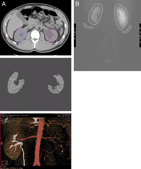 Figure 1 From Differential Renal Function Estimation Using Computerized Tomography Based Renal