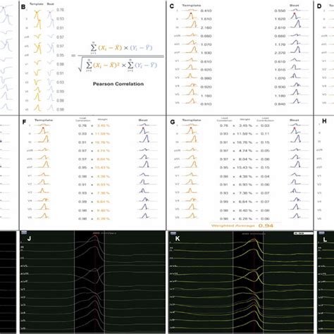 A Premature Ventricular Contraction Pvc Activation Map Projected In Download Scientific