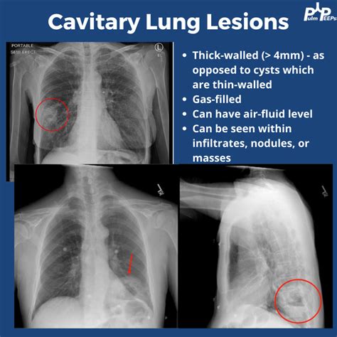 Radiology Rounds 9523 Pulmpeeps
