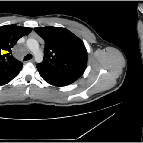Coronal And Axial Images From The Ct Of The Chest Abdomen And Pelvis