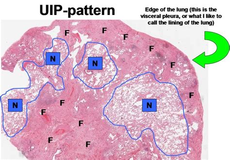 Community Participation Program For Pulmonary Fibrosis