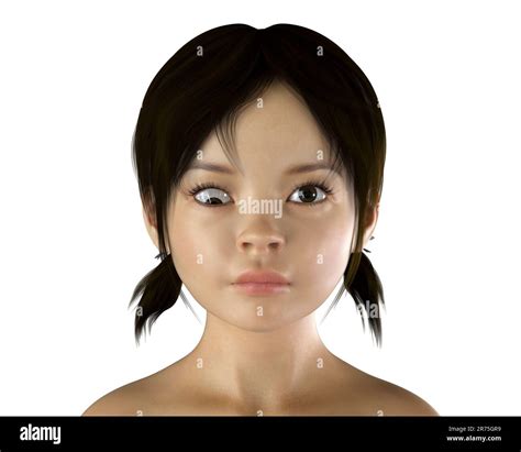 Illustration Of Hypotropia A Form Of Vertical Strabismus Where There