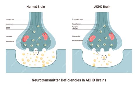 Premium Vector Adhd Brain Concept Attention Deficit Hyperactivity