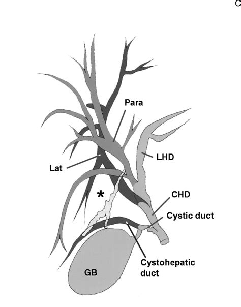Bile Duct Of Luschka Connecting With The Cystohepatic Duct The
