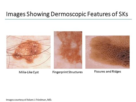 Why Seborrheic Keratosis Should Be On Your Radar Transcript