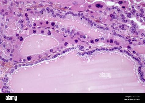 Light Micrograph Of A Section Of Thyroid Tissue Affected By Oncocytic