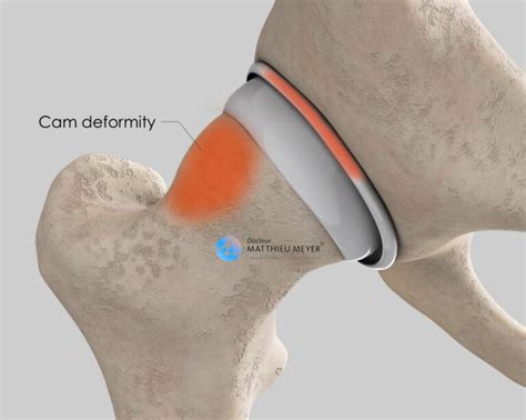 Cam Type Femoroacetabular Impingement Treatment At Heather Jean Blog