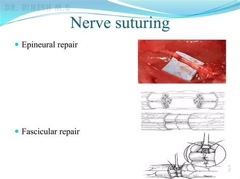 Facial Nerve Palsy And Trigeminal Neuralgia Pdf