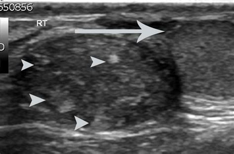 Extratesticular Scrotal Epidermoid Cyst Pacs
