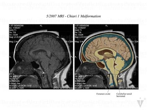 Stock Template Brain Malformations — Illustrated Verdict