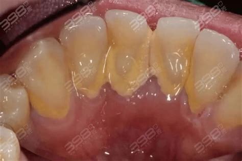 怎么判断是牙龈炎还是牙周炎？有没有区分方法都该怎么治疗？ 口腔医院新闻 398口腔网