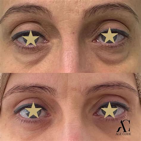 Околоочна Маска ️ Age Code Cosmetics