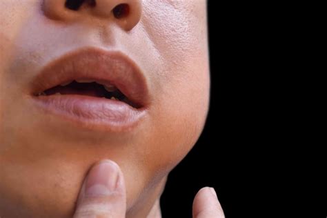 Soor Und Parotitis Definition