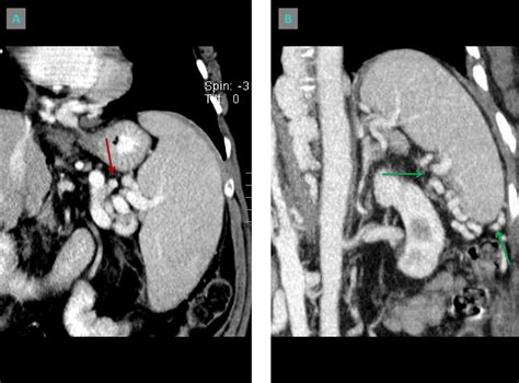 Perisplenic Network Varices A And B Are Oblique Coronal Images From