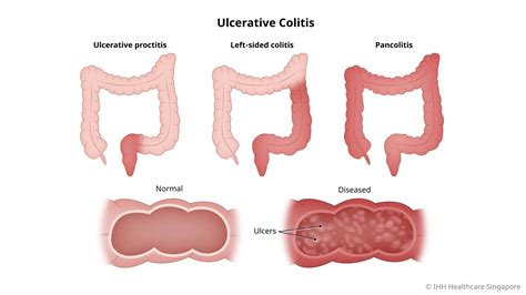 Ulcerative Colitis Causes And Symptoms Parkway East Hospital