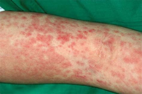 Erythematous Plaques With Dusky Centers Open I