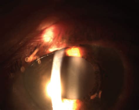 Crstoday Iol Calcification