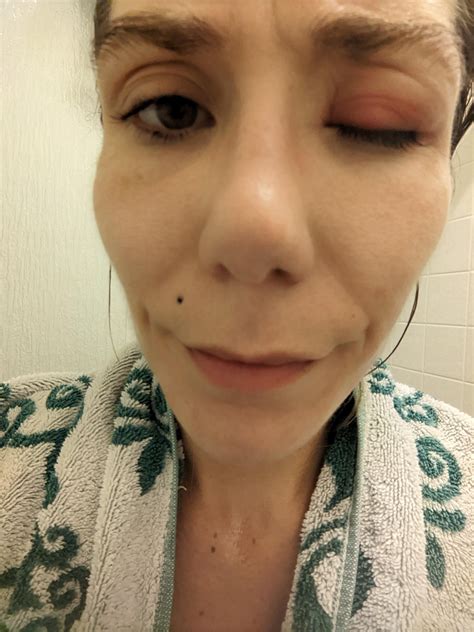 Is This Blepharitis Or Chalazion Rblepharitis