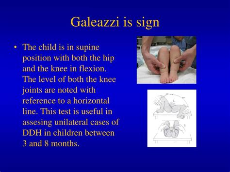 Ppt Develompmental Dysplasia Of The Hip Ddh Powerpoint
