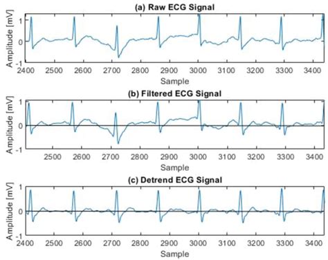 Ecg Signal Through Pre Processing Process Download Scientific Diagram
