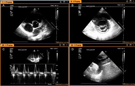 Normal Echocardiogram