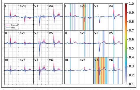 Figure 1 From Discovering And Visualizing Disease Specific Electrocardiogram Features Using Deep