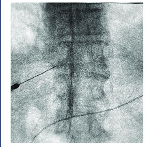 X Ray Image Of The Thoracic Spine Radiofrequency Thermocoagulation Is Download Scientific