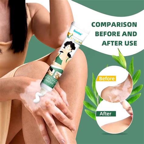 Крем натуральный травяной для ухода за кожей от витилиго гиперпигментации побелевшей кожи 20 г