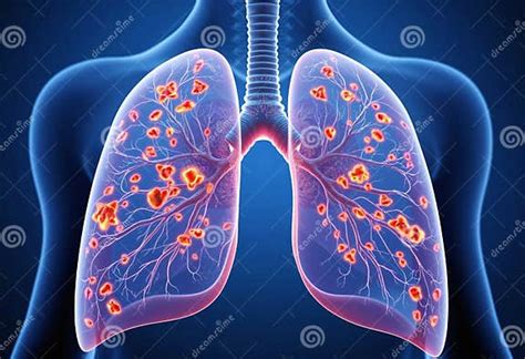 Illustration Of Human Lungs Affected By Tuberculosis Showing Lesions