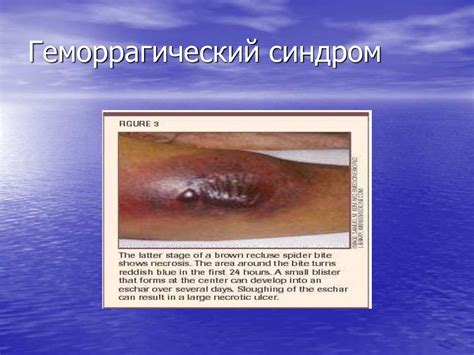 Апластические анемии у детей презентация онлайн