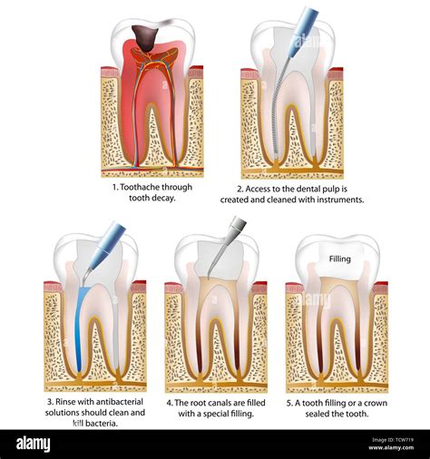 Dental Caries Process