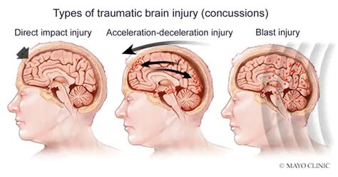 Different Types Of A Tbi Horizon Tbi And Brain Center