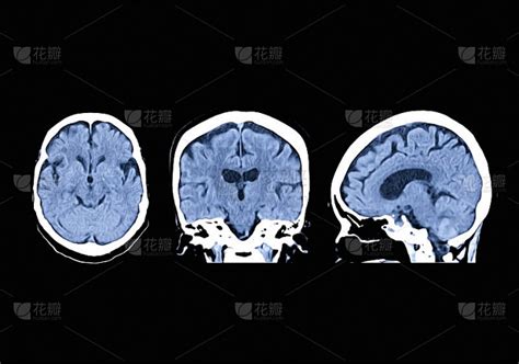 采集脑ct扫描轴向、矢状、冠状面与导向线定位。ct脑扫描。油画效果。