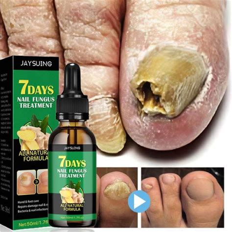 Jual Nail Fungal Treatment Essence Oil Foot Toe Nail Fungus Removal