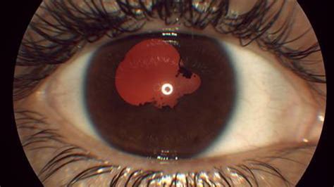 Qué Es La Uveítis La Enfermedad Rara En La Parte Interna De Los Ojos