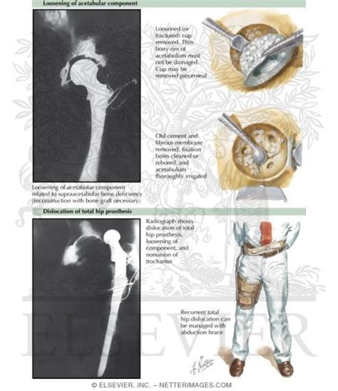 Loosening Of Acetabular Component Dislocation Of Total Hip Prosthesis