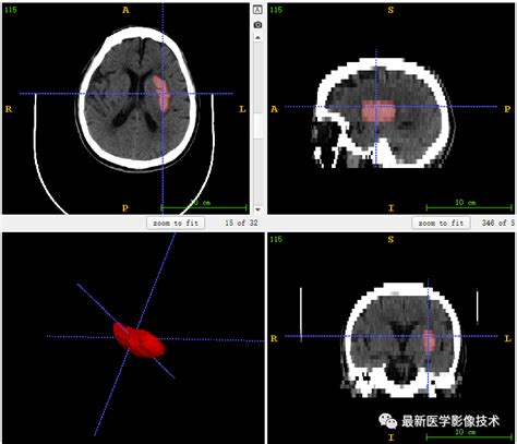 2022instance——颅内出血分割挑战 腾讯云开发者社区 腾讯云
