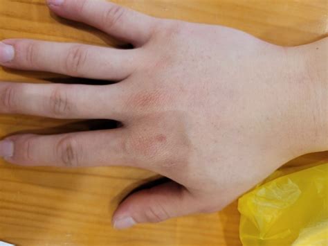 오른손등과 손가락에 붉은점들 지식in