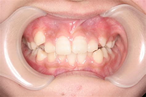 八重歯なんですが菰野町出来るだけ歯を抜かない矯正歯科｜八重歯 ｜四日市市・いなべ市・桑名市・菰野町で矯正をお考えなら安心価格の大長歯科矯正歯科へ