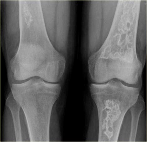 The Radiology Assistant Sclerotic Bone Tumors