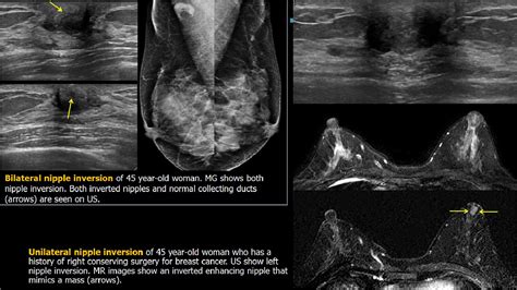 Sonographic Evaluation And Various Diseases Of The Nipple Areolar