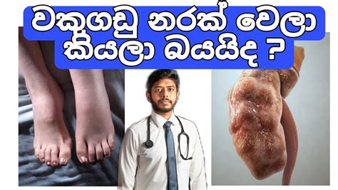 වකුගඩු නරක්වීම පෙන්වන ලක්ෂණ මෙන්න හේතු හා වකුගඩු ආරක්ෂා කරන ආහාර Renal Disease Symptoms