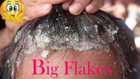Itchy Dry Scalp Scratching Dandruff Lice Comb Youtube
