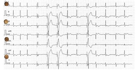 Aflutter Or Afib I See That Its Irregular And In Certain Leads At Times It Looks Definitely