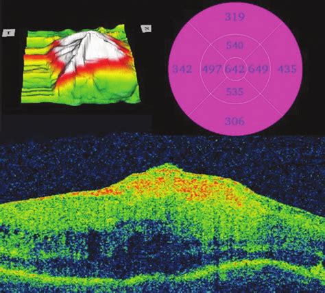 Hypotony Maculopathy Using Sd Oct Color Coded Topographical Maps Upper