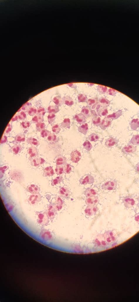 Dr Dhanji Rajani Auf Linkedin Intracellular Gram Negative Cocci Gonococci Urethral Swab