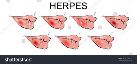 Illustration Different Stages Cold Sores Inflammation Stock Vector