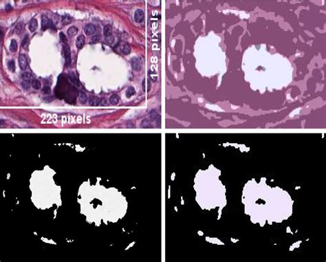 Segmentation Of A Breast Tissue In The Second Row We Have Shown The