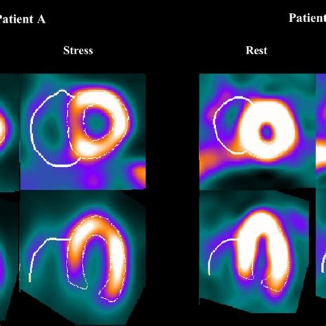 Two Sample Patients Right And Left Ventricular Segmentation By